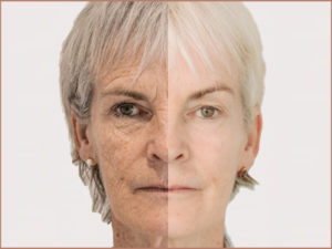 Morpheus 8: All you need to know about Judy Murray’s facelift ...